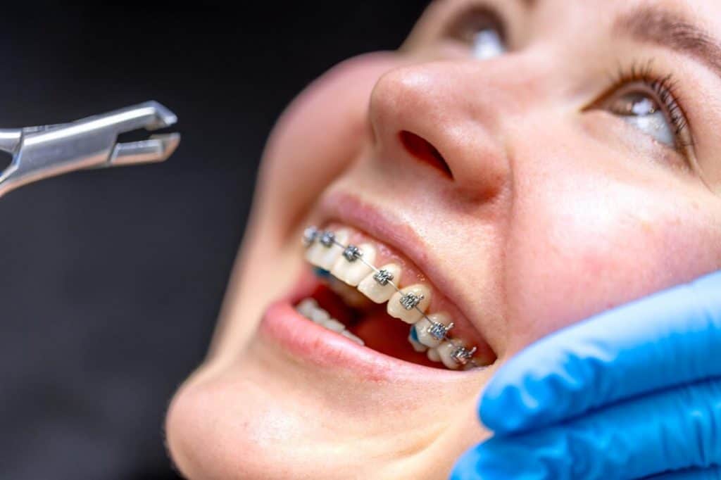 Adult Braces: Options And Benefits Explained