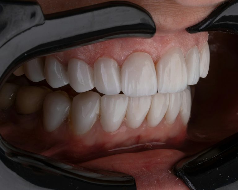 Porcelain Vs Composite Veneers: Austin Guide